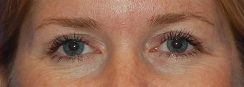 Eyelid Surgery Before & After Case # 658 | Scottsdale Center for ...